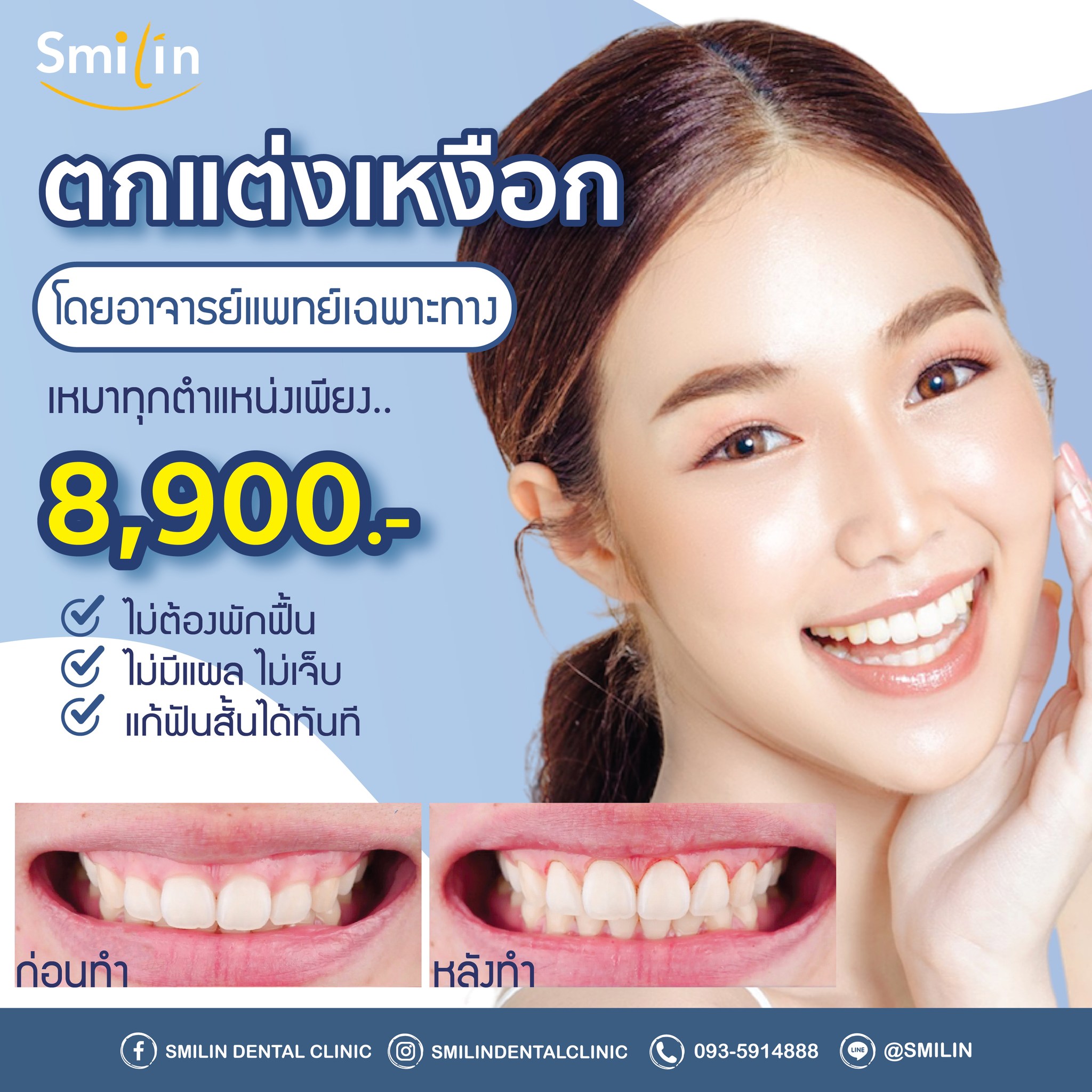 คลินิกทันตกรรม กรุงเทพ | รากฟันเทียม จัดฟัน วีเนียร์ – Smilin Dental Clinic